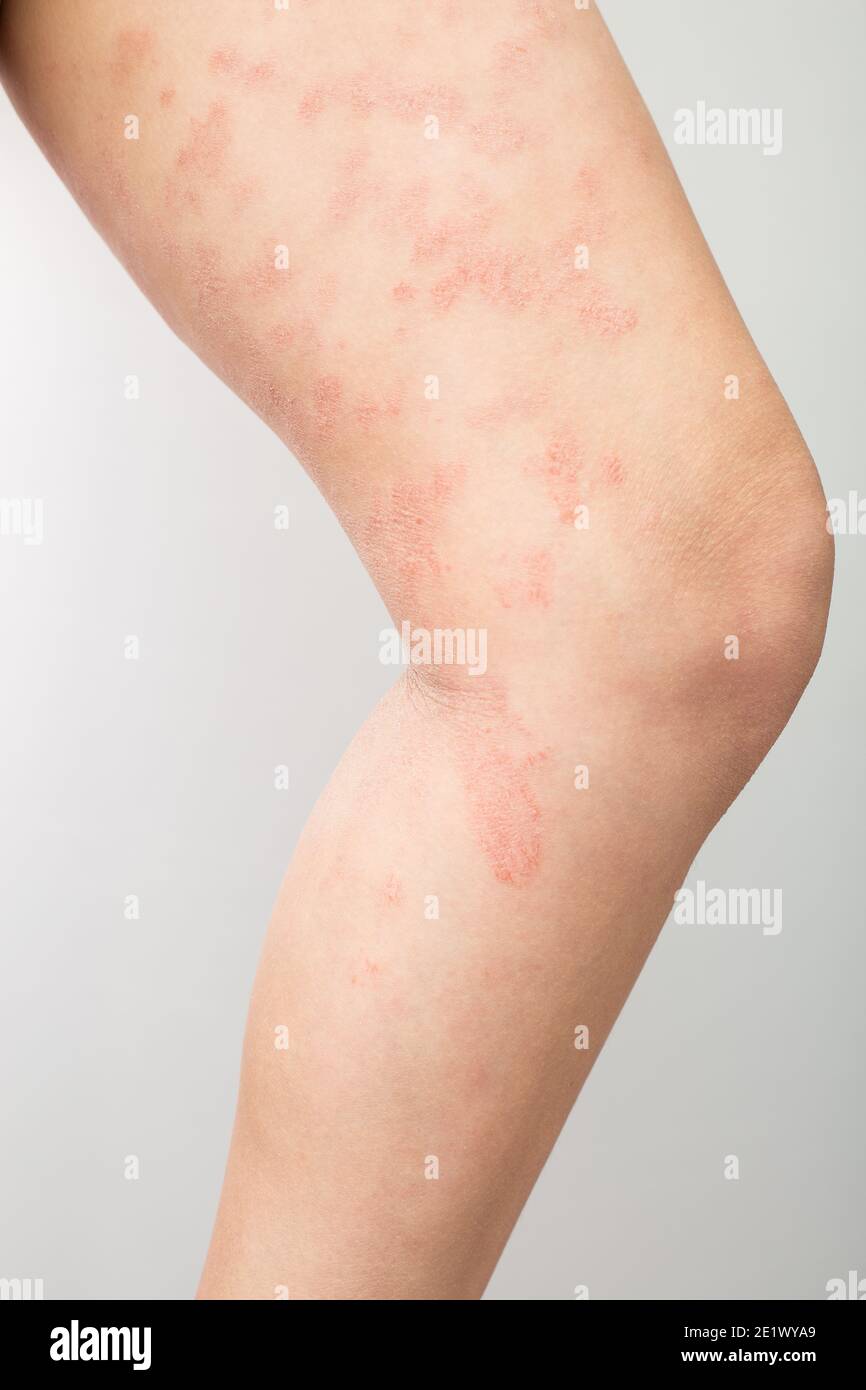 Acute atopic dermatitis on the legs behind the knees of a child is a ...