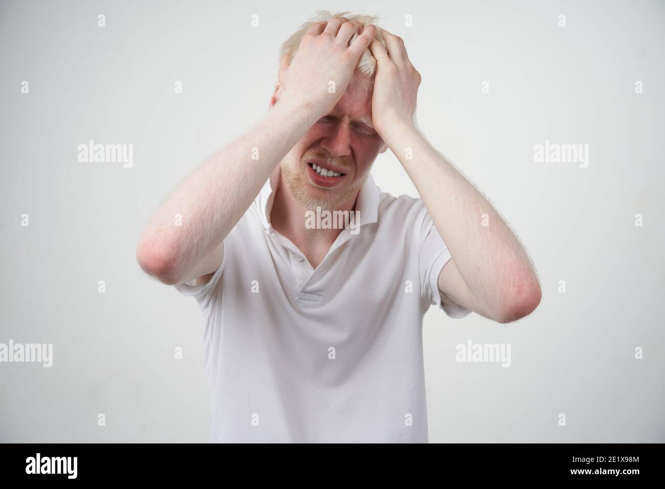 albinism Sad albino man white skin hair studio dressed t-shirt isolated ...
