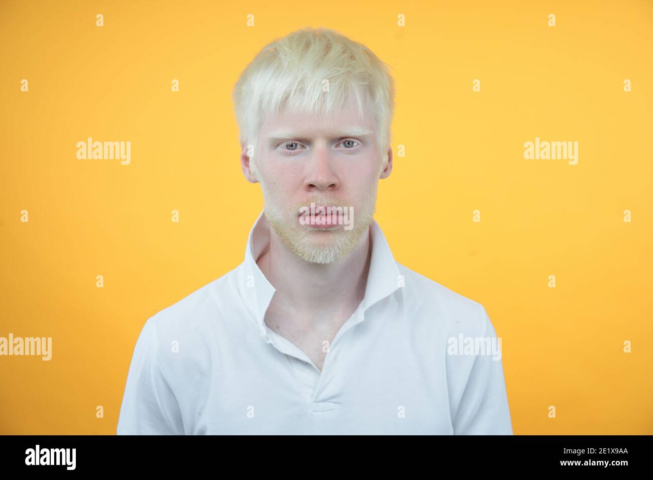 albinism Sad albino man white skin hair studio dressed t-shirt isolated ...