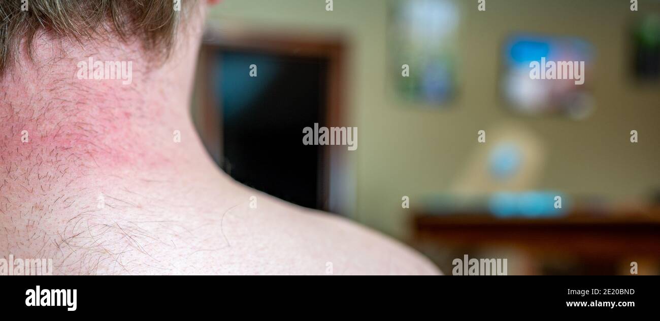 Back hair caused by increased age on a white male Stock Photo - Alamy