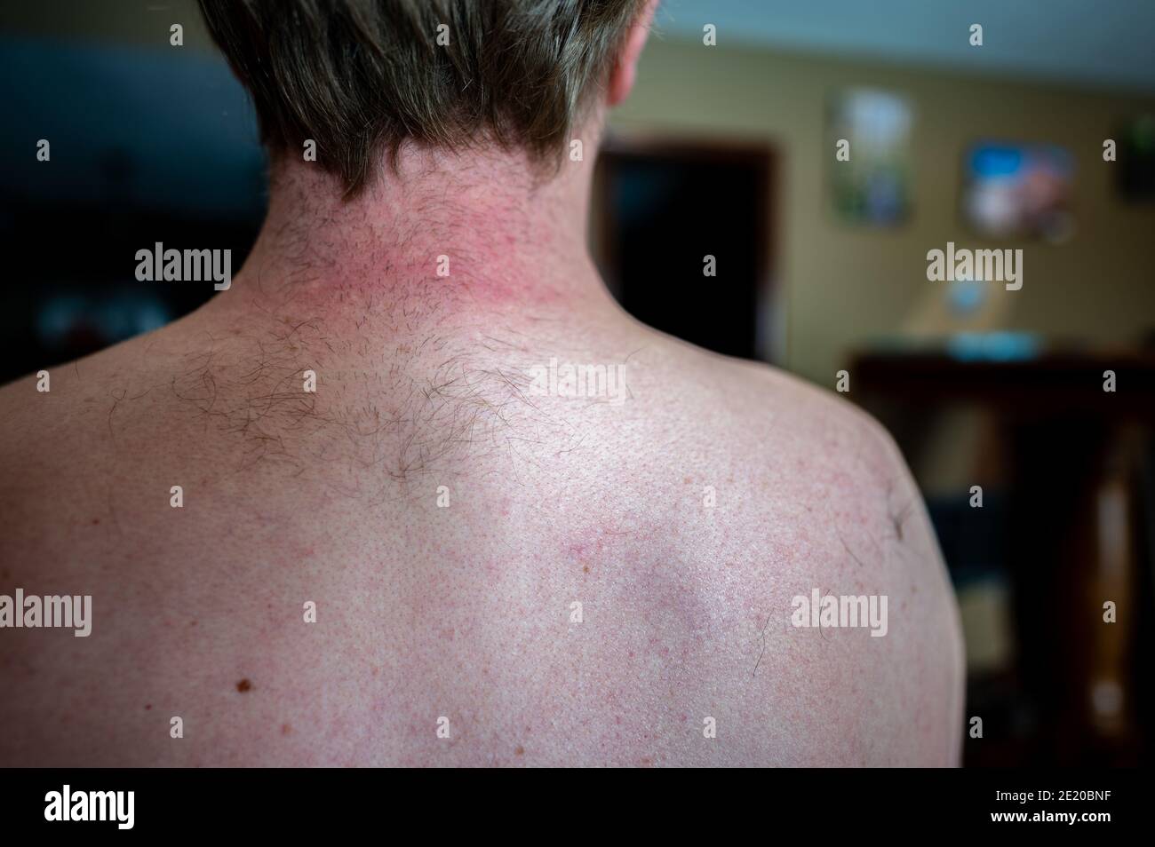 Back hair caused by increased age on a white male Stock Photo - Alamy