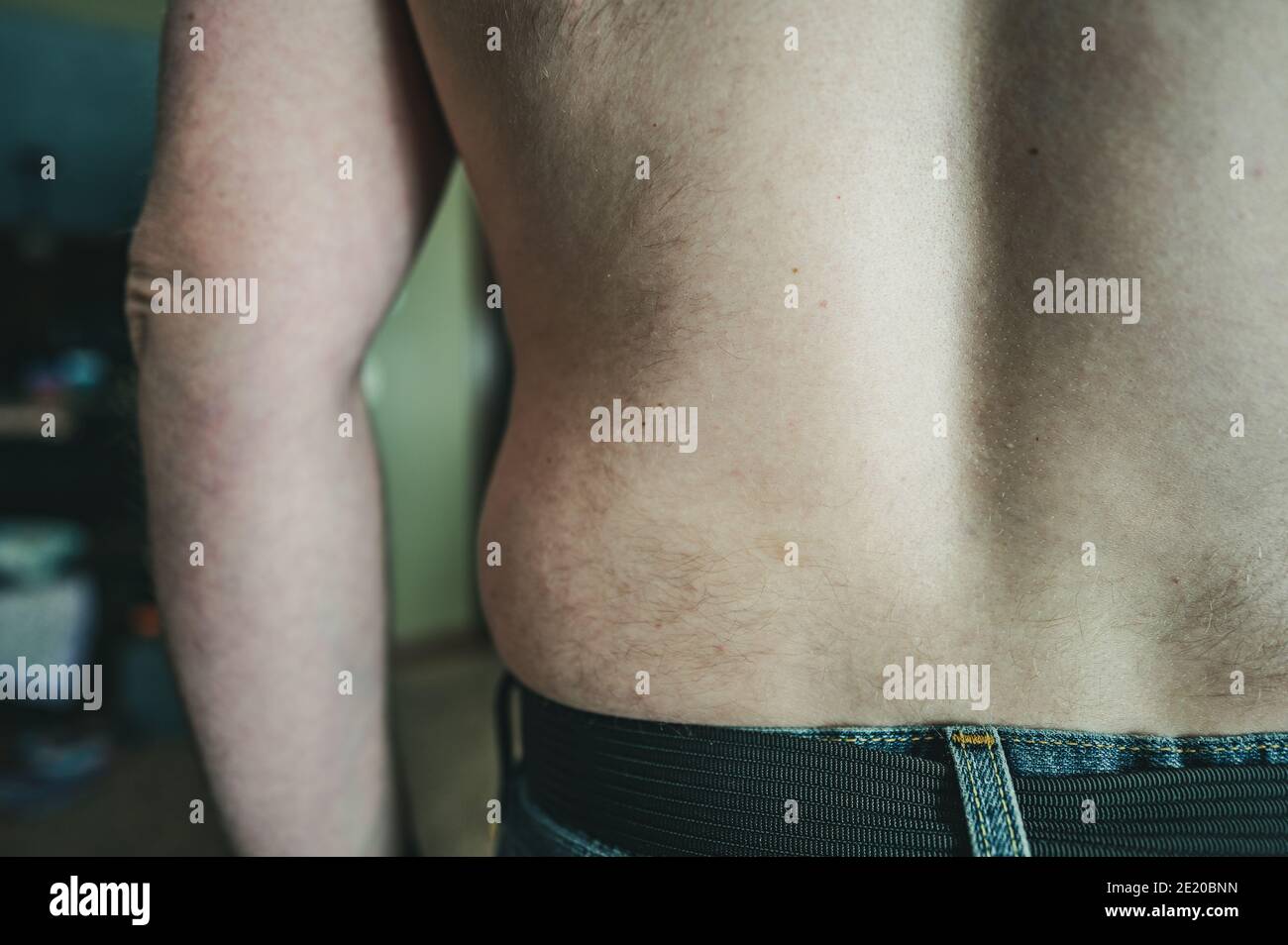 Back hair caused by increased age on a white male Stock Photo - Alamy