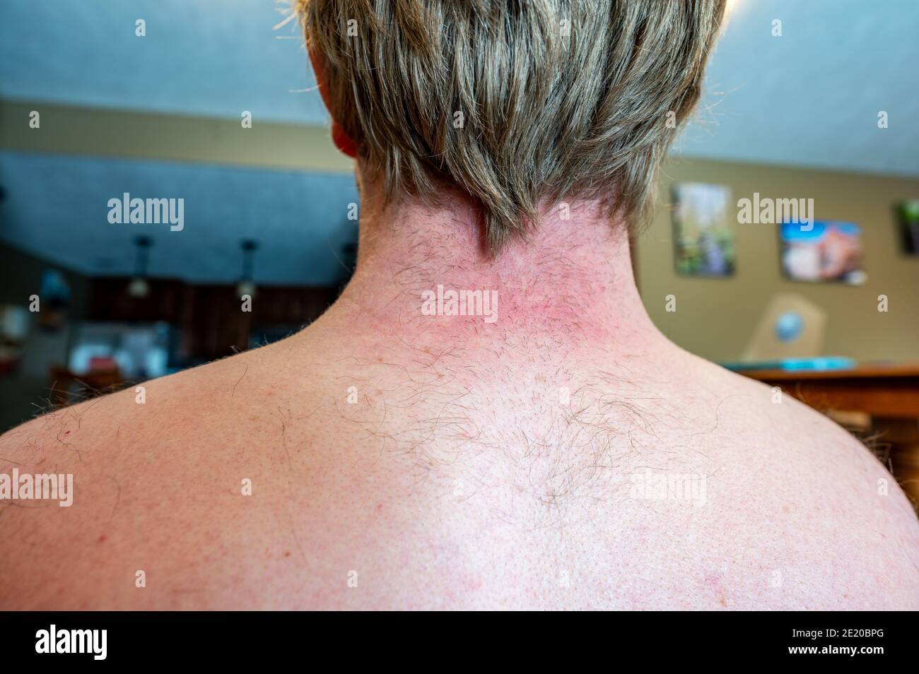 Back hair caused by increased age on a white male Stock Photo - Alamy
