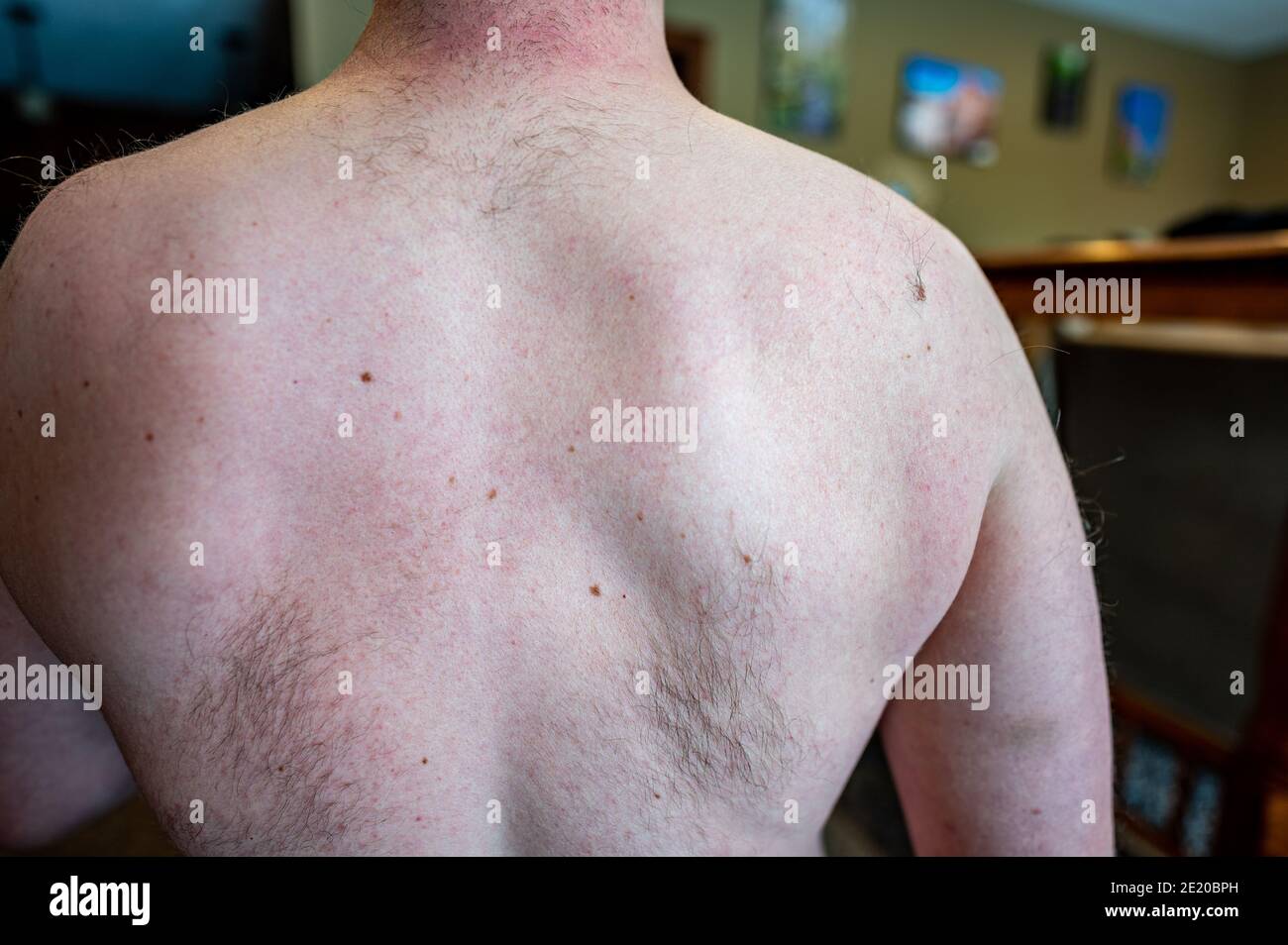 Back hair caused by increased age on a white male Stock Photo - Alamy