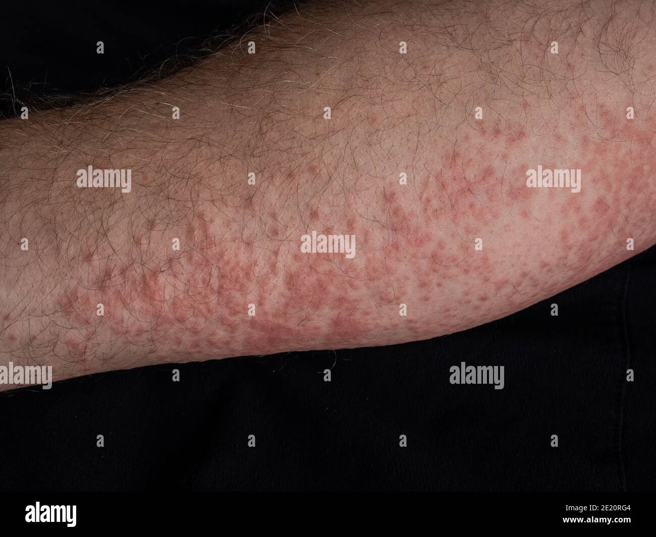 Skin of male hand with symptoms of contact allergy. Close up of hives ...