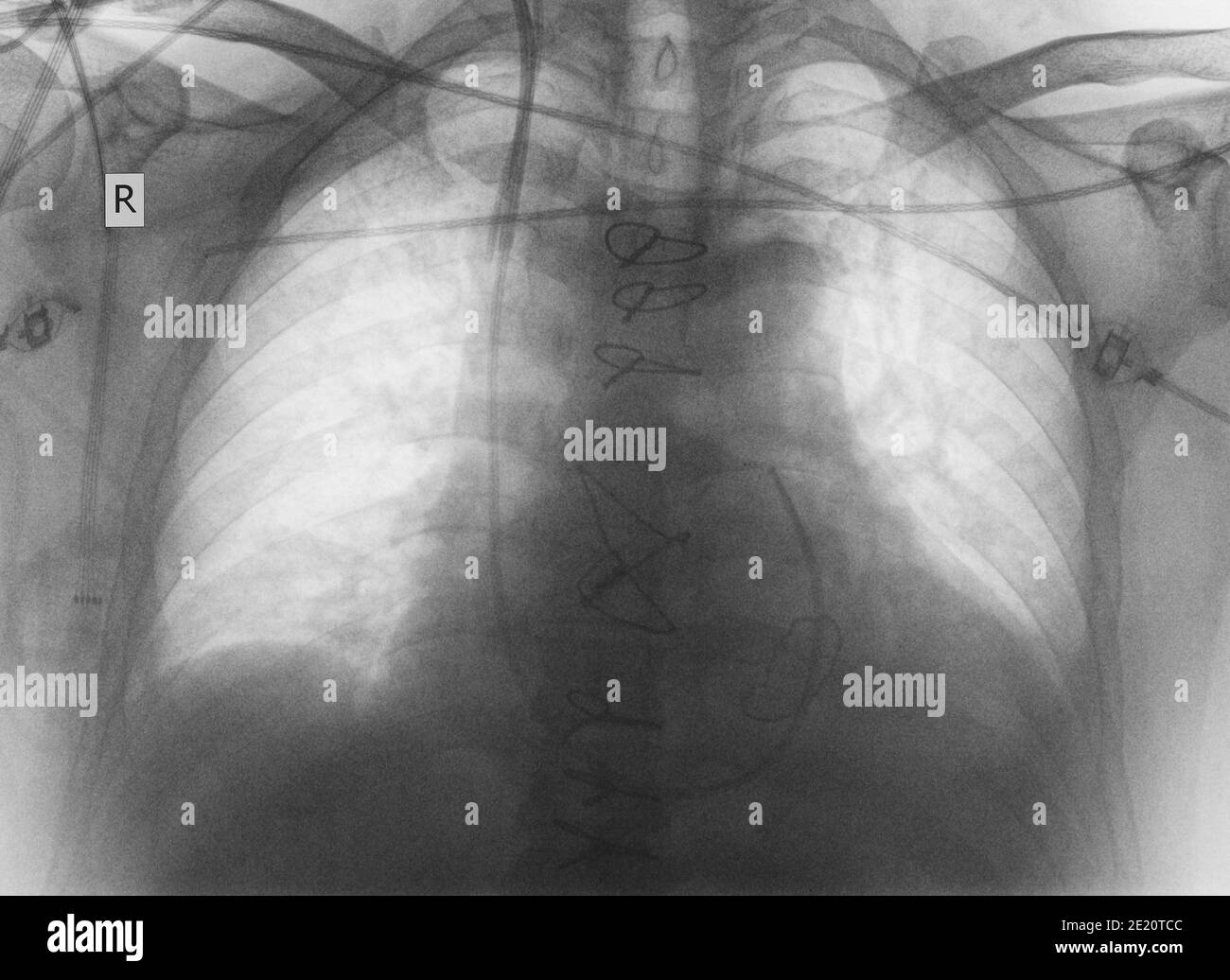 Chest x ray of patient with copd hi-res stock photography and images ...