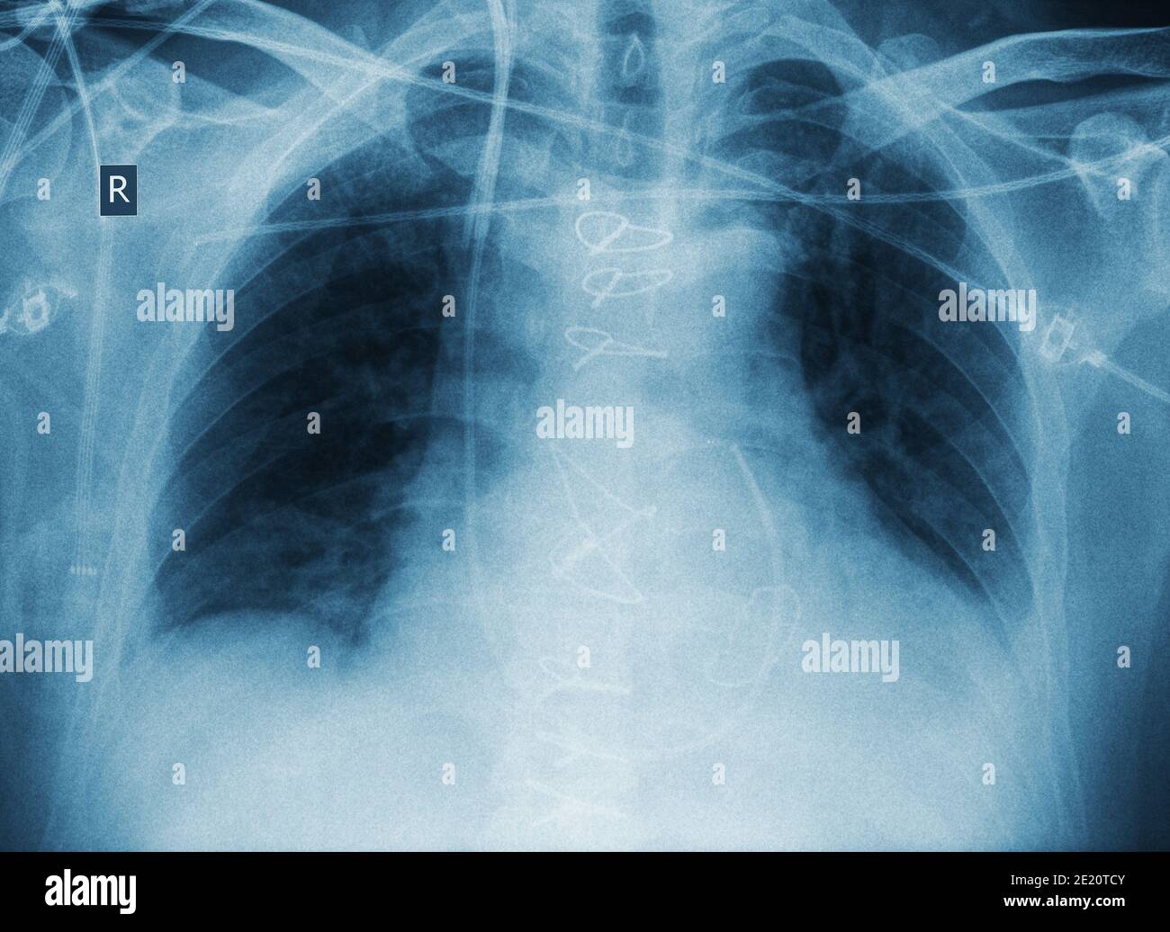 X-ray image of patient after surgical operation Stock Photo - Alamy