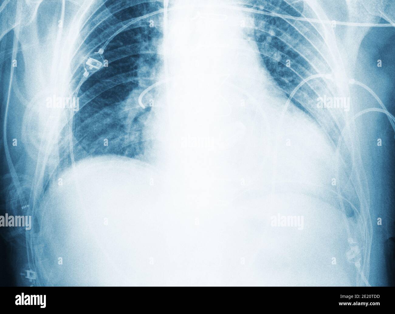 X-ray scan of patient`s chest after surgery Stock Photo - Alamy