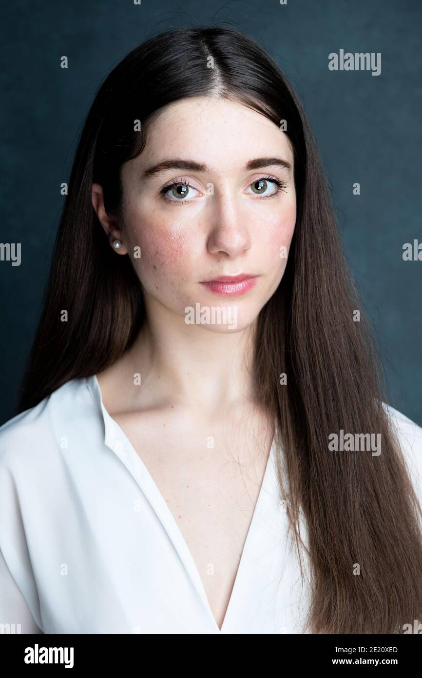 Female with skin rash on face Stock Photo - Alamy
