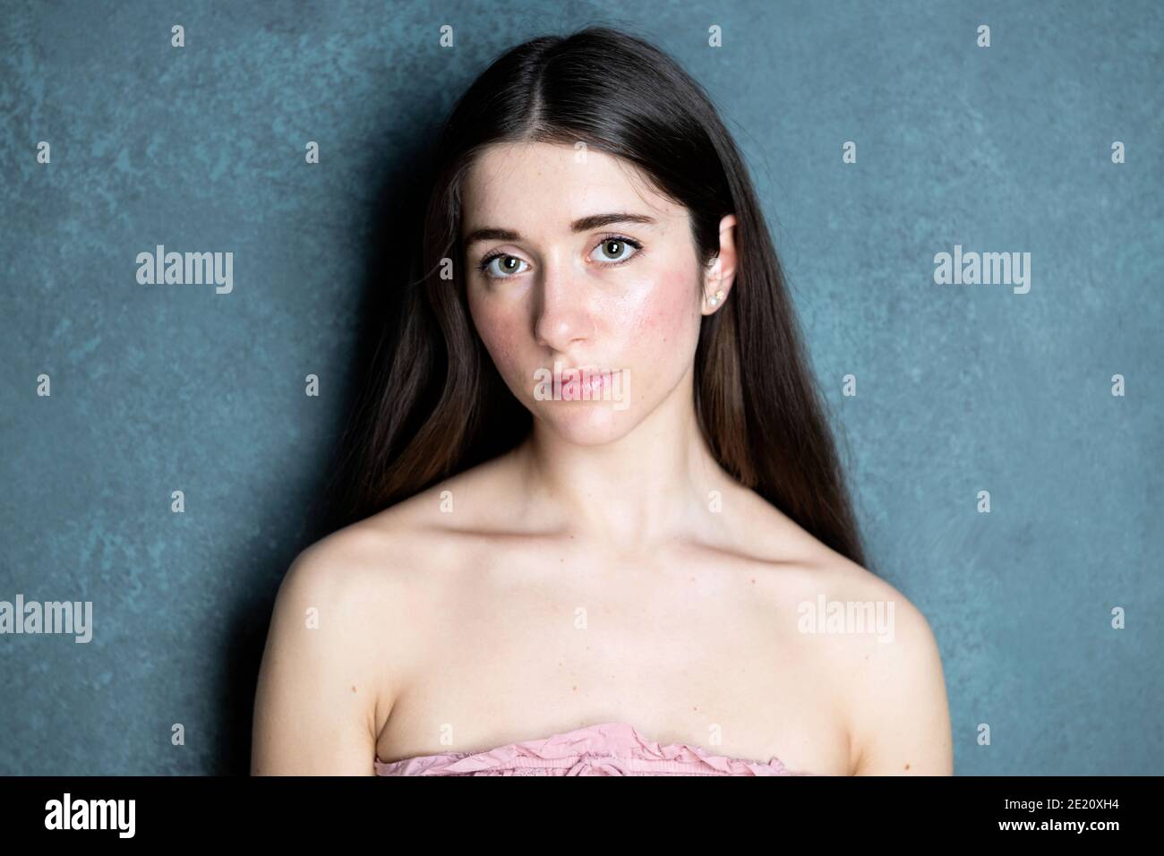 Female with skin rash on face Stock Photo - Alamy