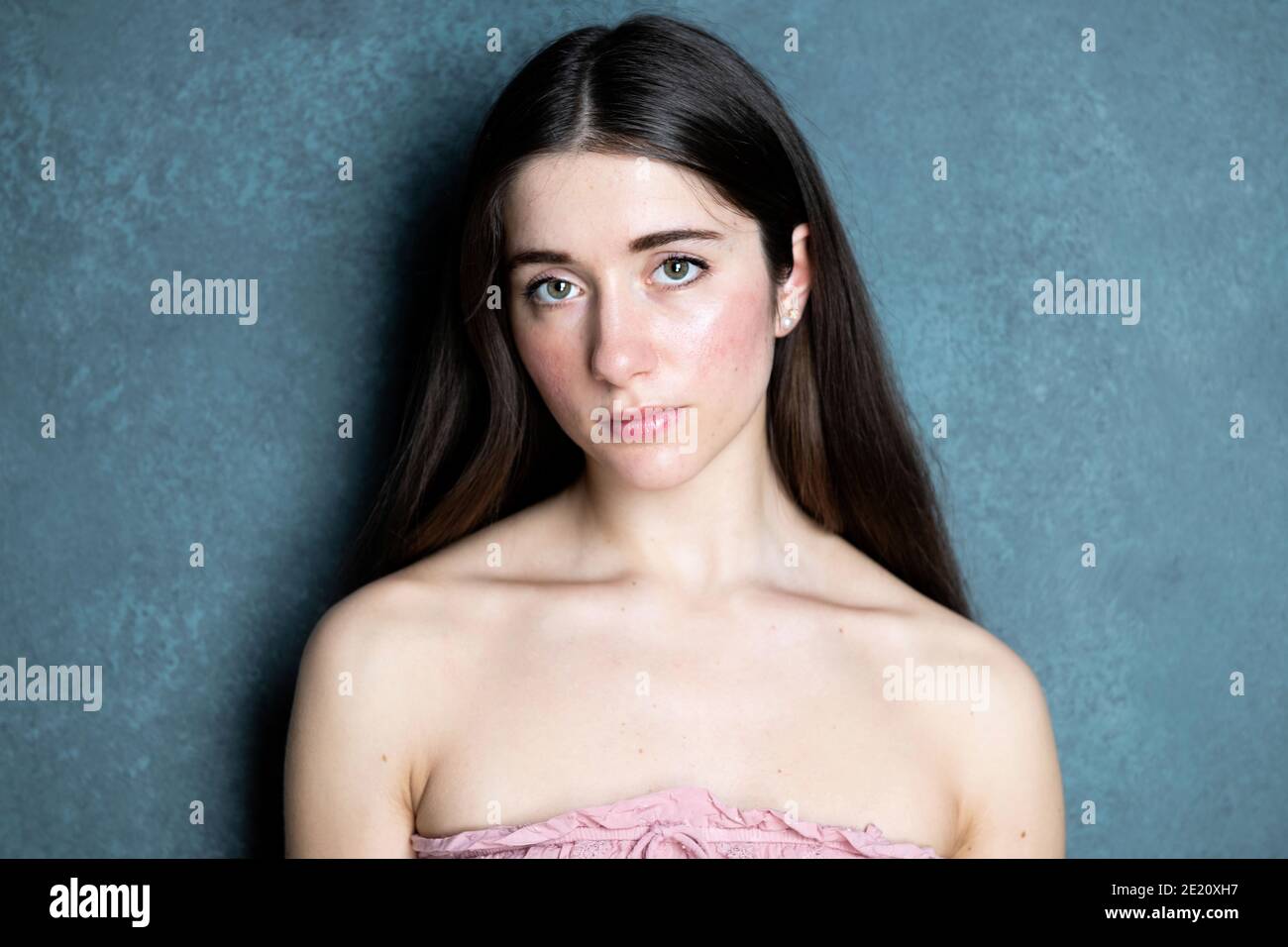 Female with skin rash on face Stock Photo - Alamy