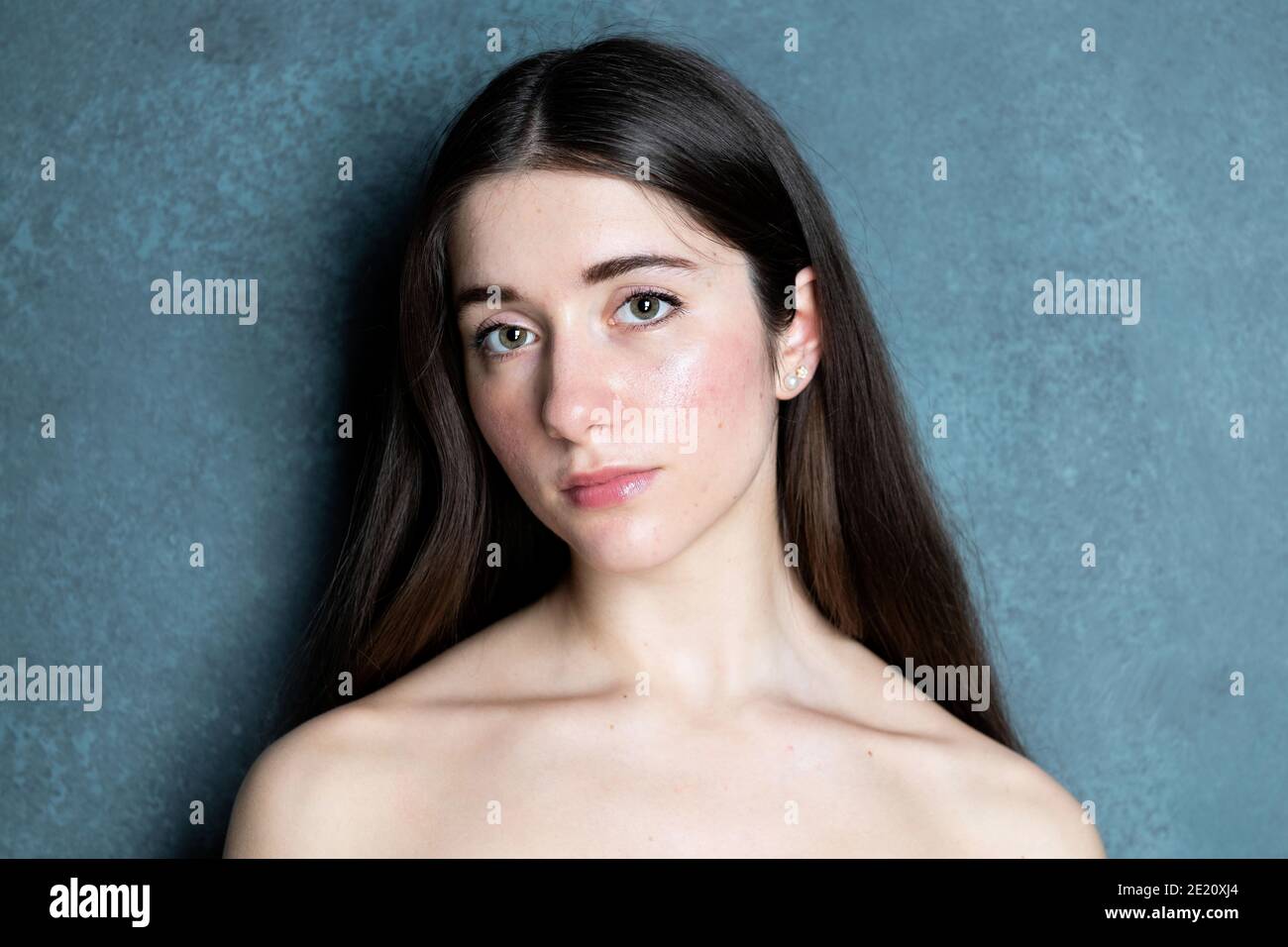 Female with skin rash on face Stock Photo - Alamy