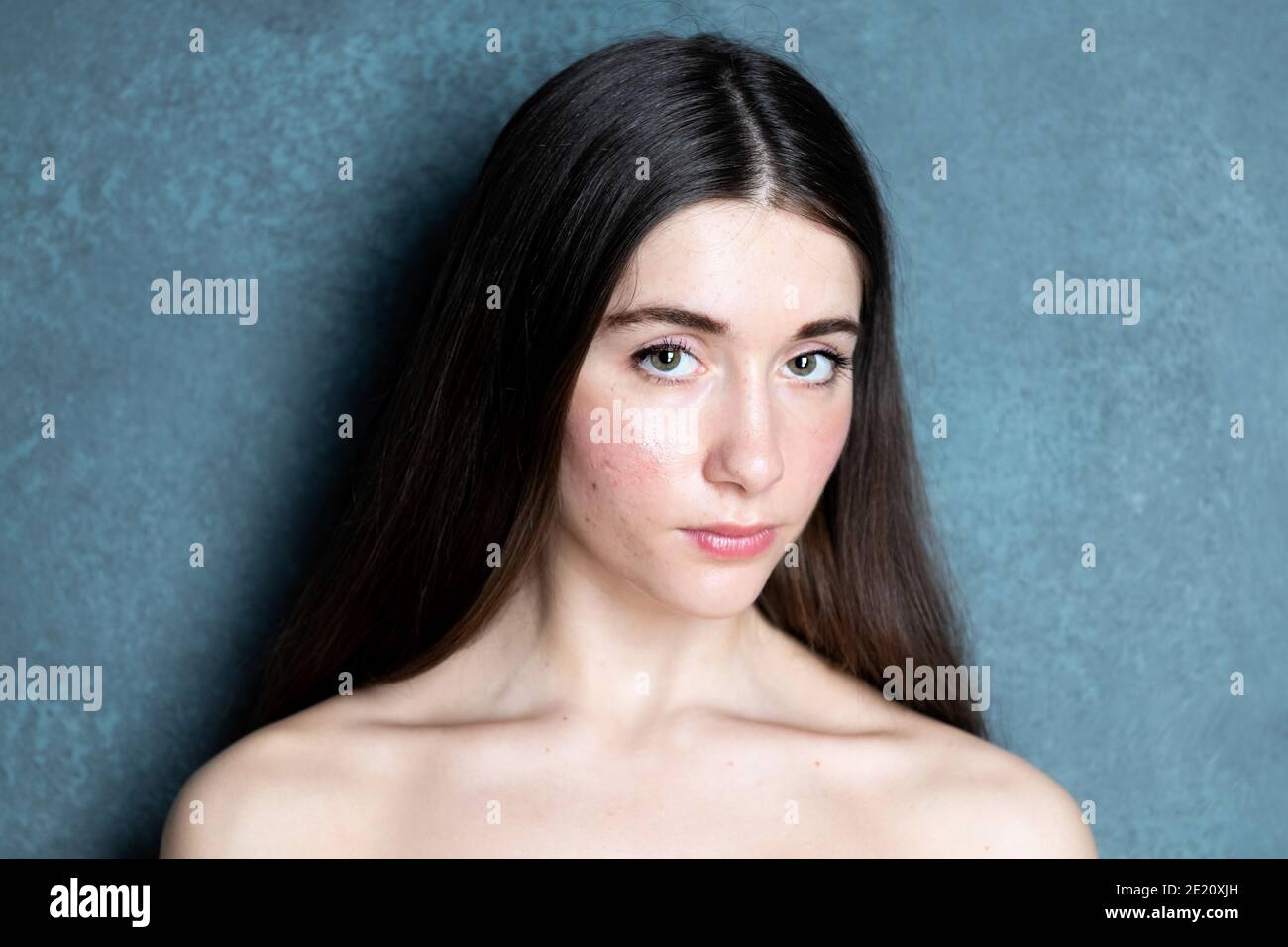 Female with skin rash on face Stock Photo - Alamy