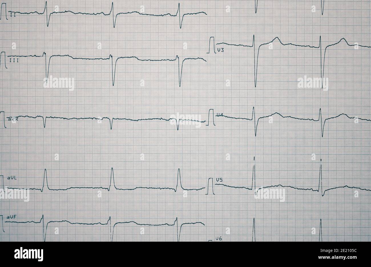 ECG record on the paper as a medical background Stock Photo - Alamy