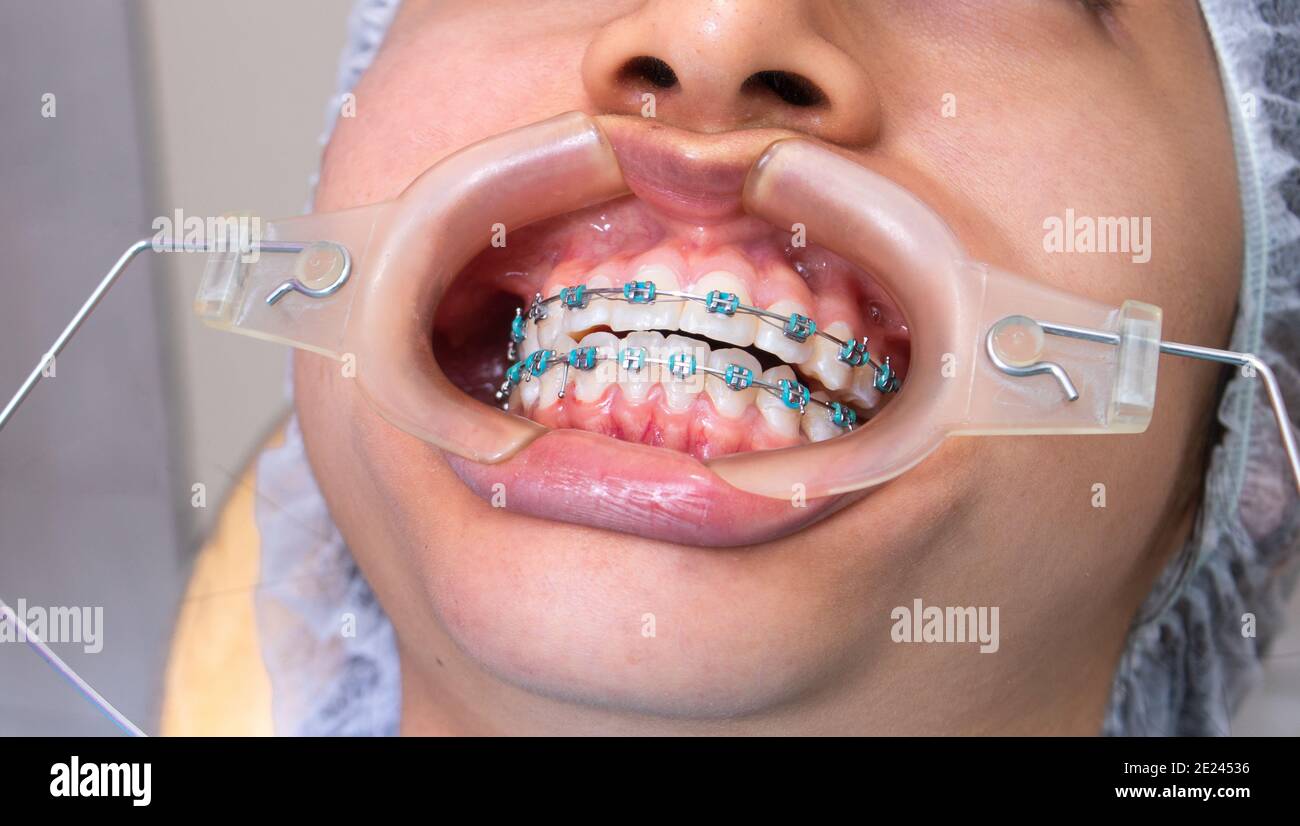 Closeup of a patient with an open mouth in dentistry wearing teeth ...