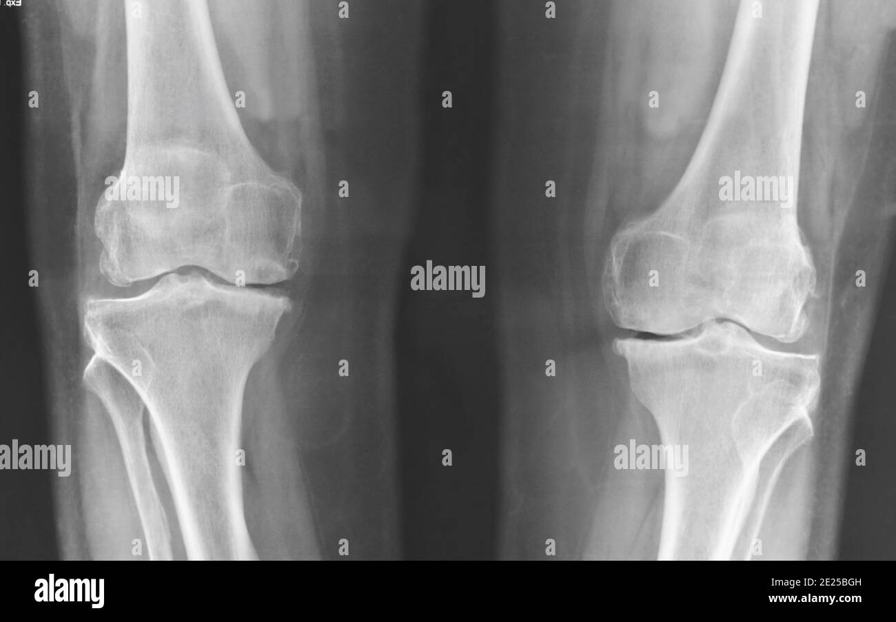 X-ray image of a knee Stock Photo - Alamy
