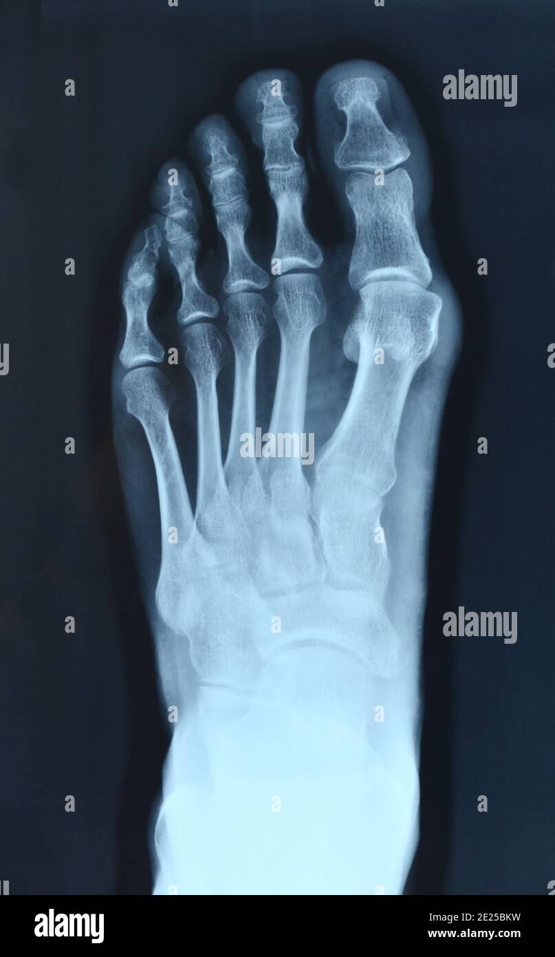 X Ray Foot Normal