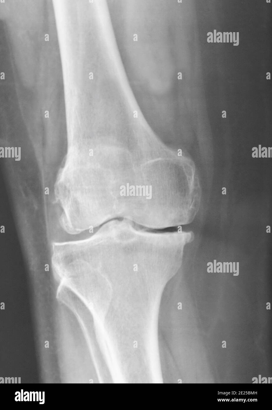 X-ray image of a knee Stock Photo - Alamy
