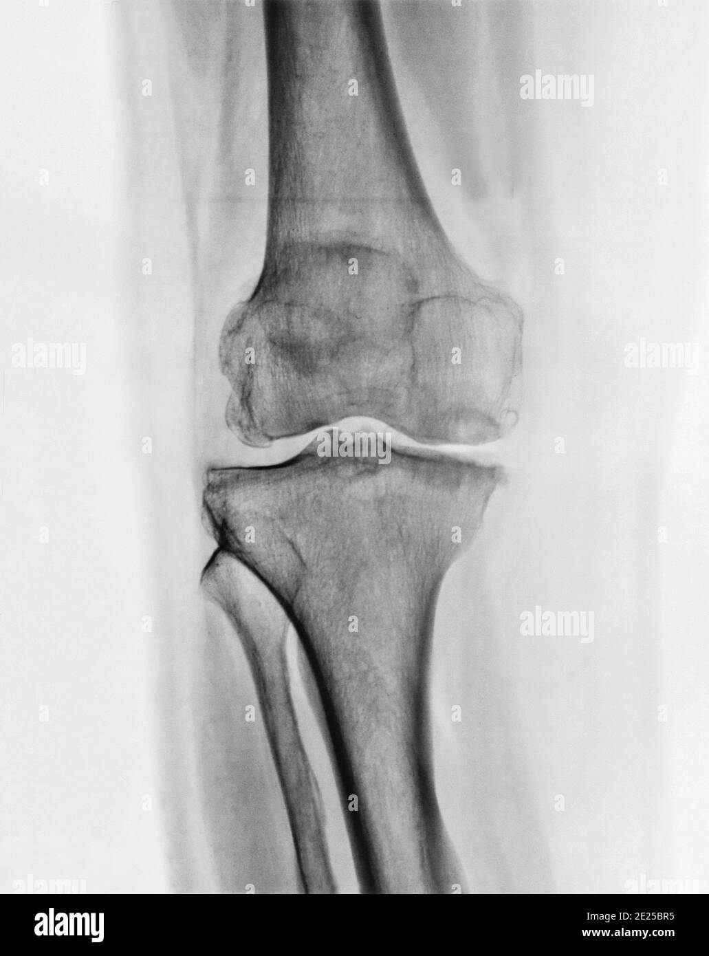 Knee joint radiology color Black and White Stock Photos & Images - Alamy