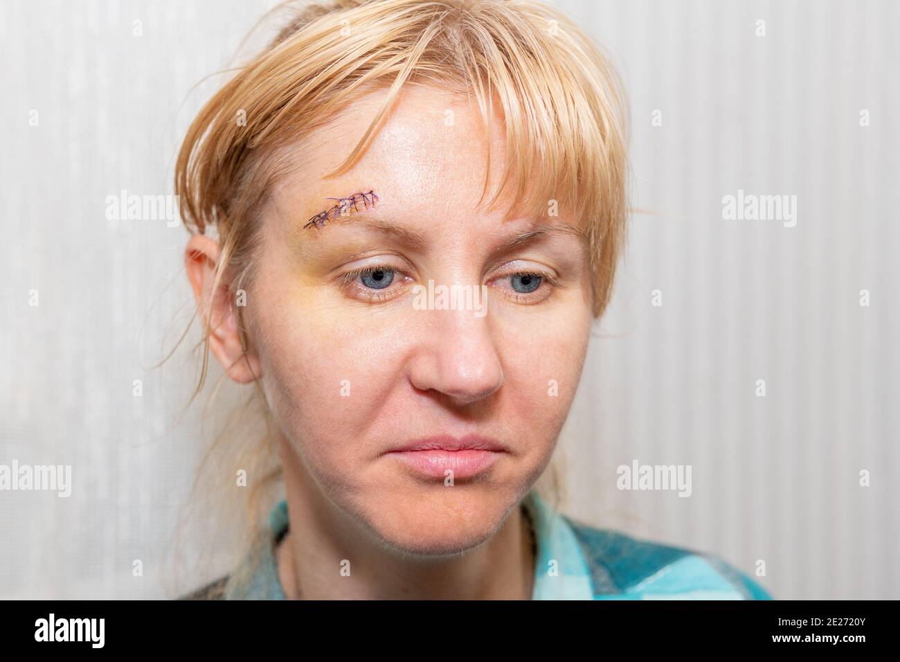 Eyebrow wound hi-res stock photography and images - Alamy