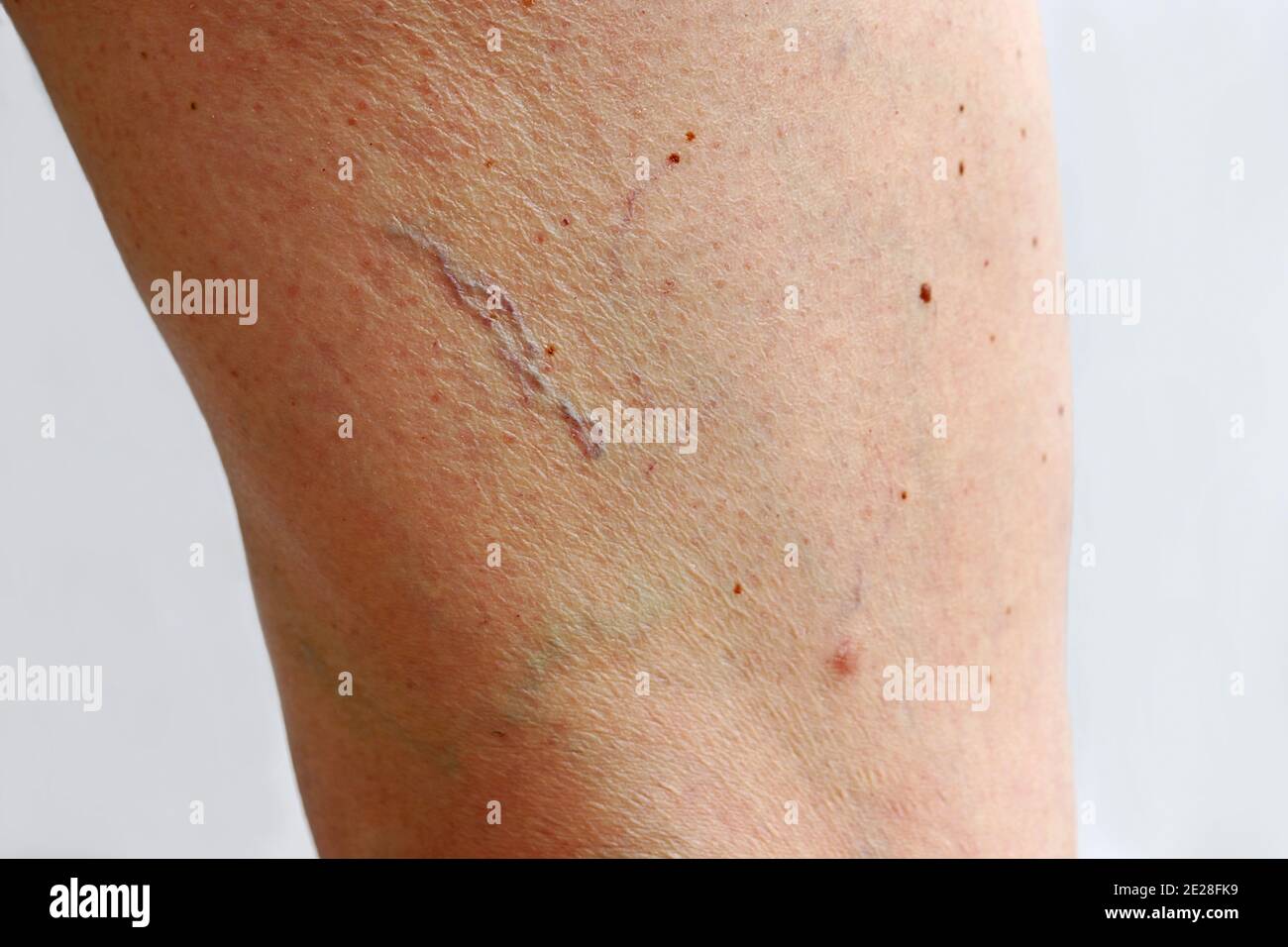 Connective tissue weakness hi-res stock photography and images - Alamy