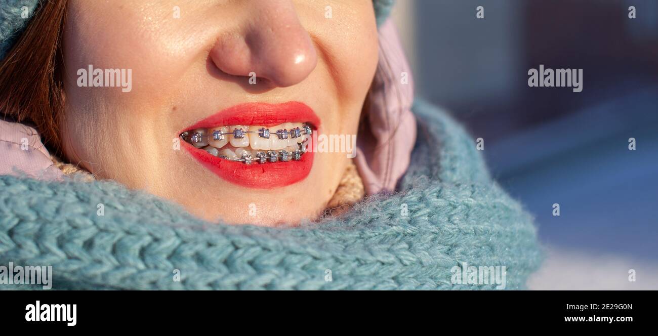 The girl has braces on her teeth. A girl in the winter on the street ...