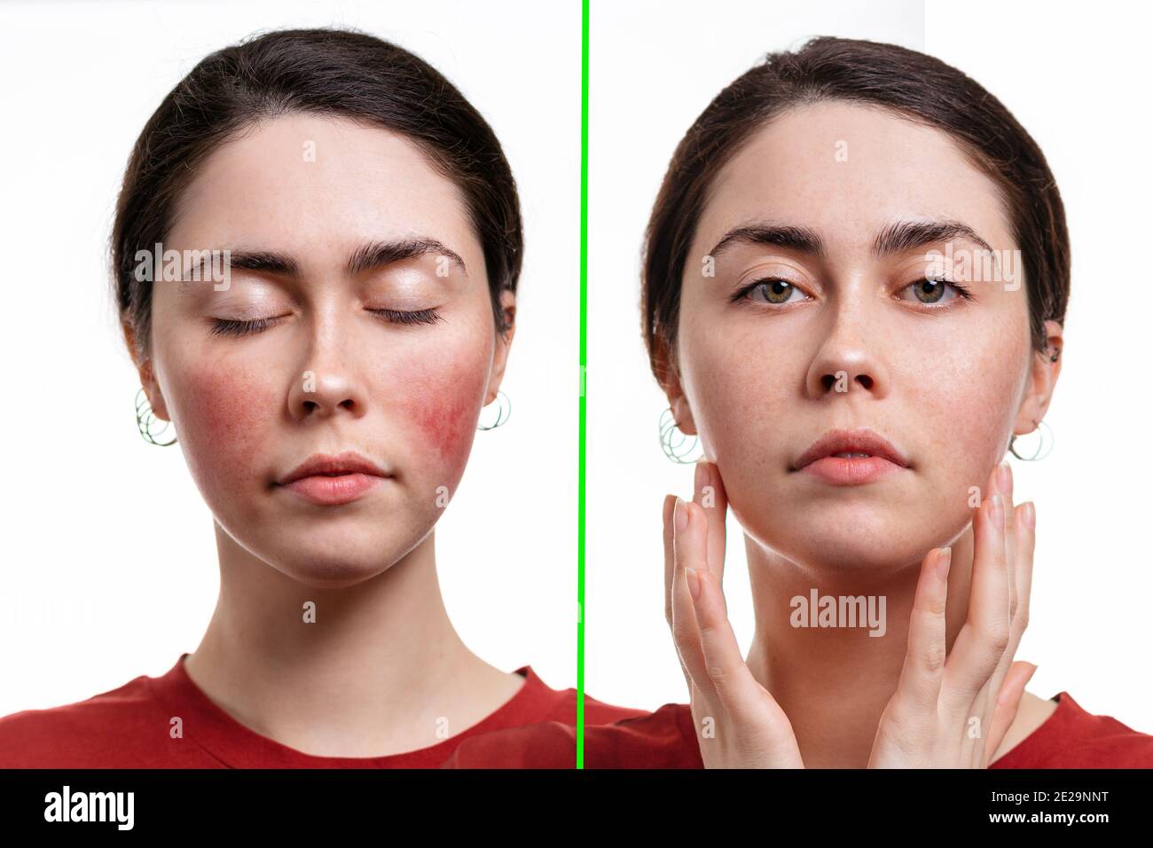 Two portraits of a young woman with rosacea on her cheeks and without ...