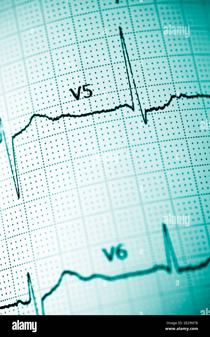 Ekg paper hi-res stock photography and images - Alamy