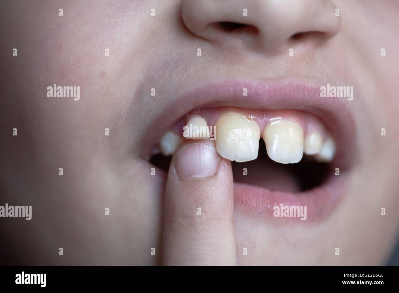 loss of a baby tooth in an eight-year-old child, at the last stage ...