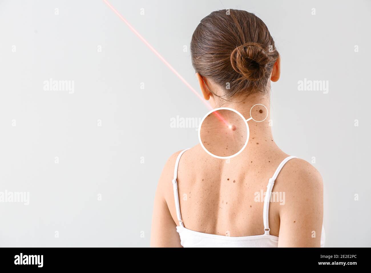 Young woman undergoing procedure of nevus removal by laser on light ...