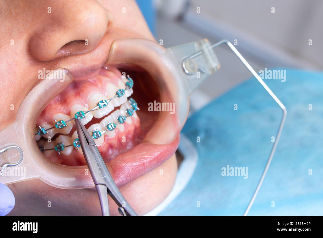 High angle shot of a doctor fixing the patient's braces using dental ...