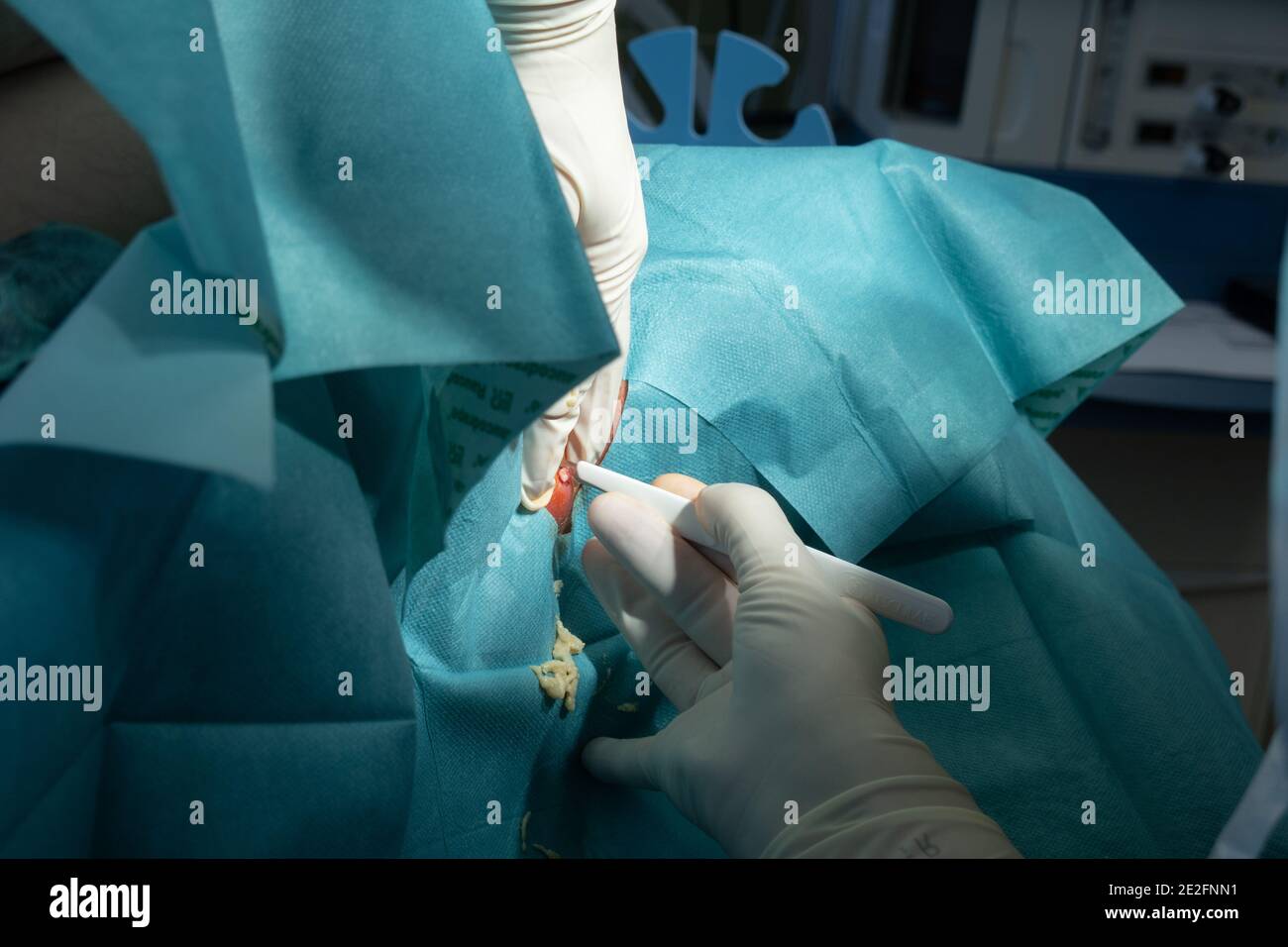 a surgeon opens a large abscess with a scalpel in a hospital Stock ...