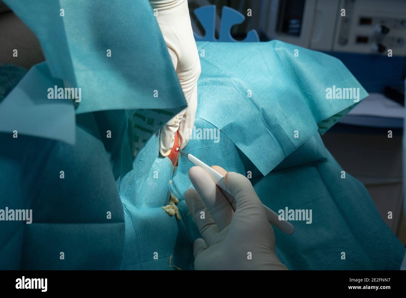 a surgeon opens a large abscess with a scalpel in a hospital Stock ...
