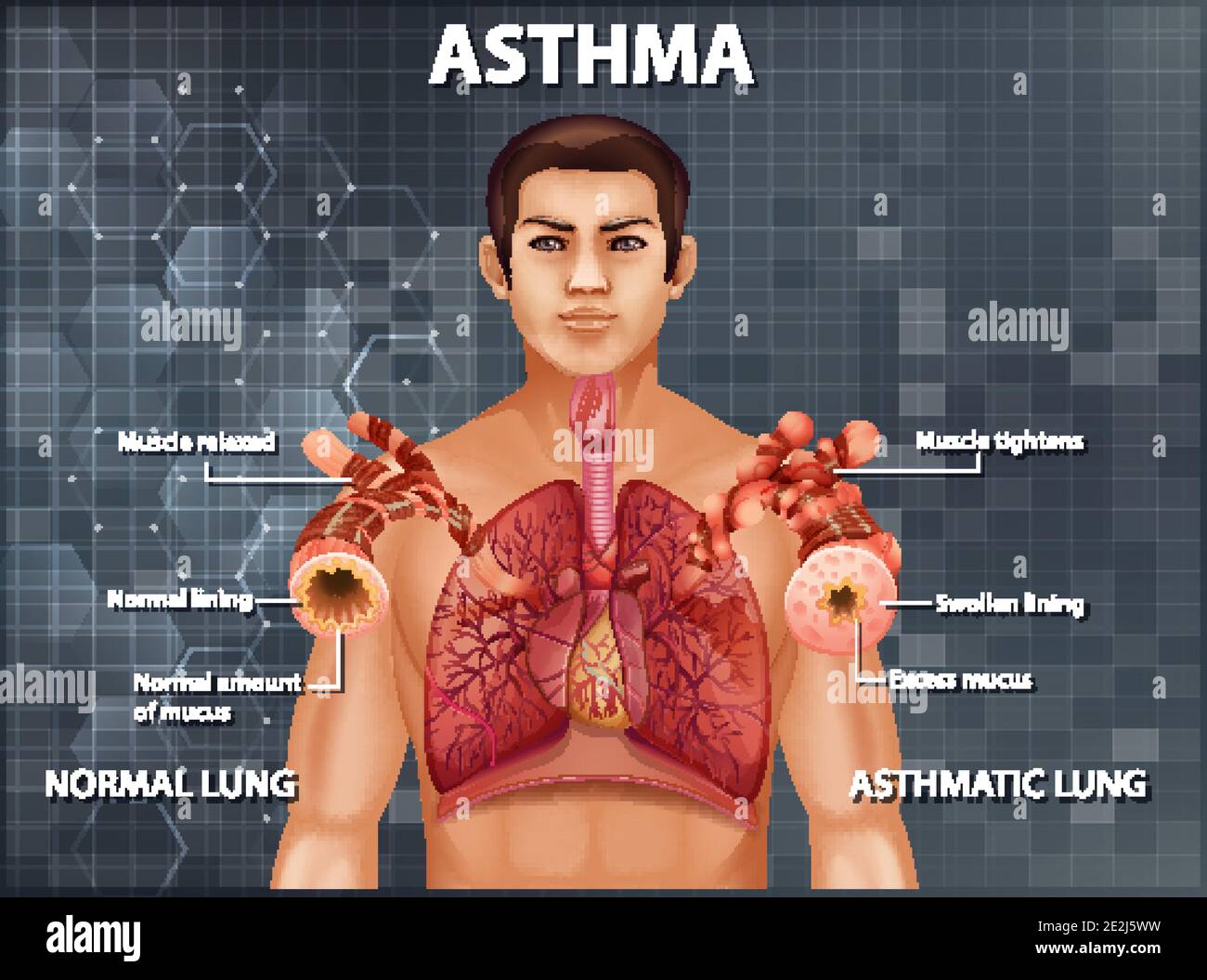 Comparison of healthy lung and Asthmatic lung illustration Stock Vector ...