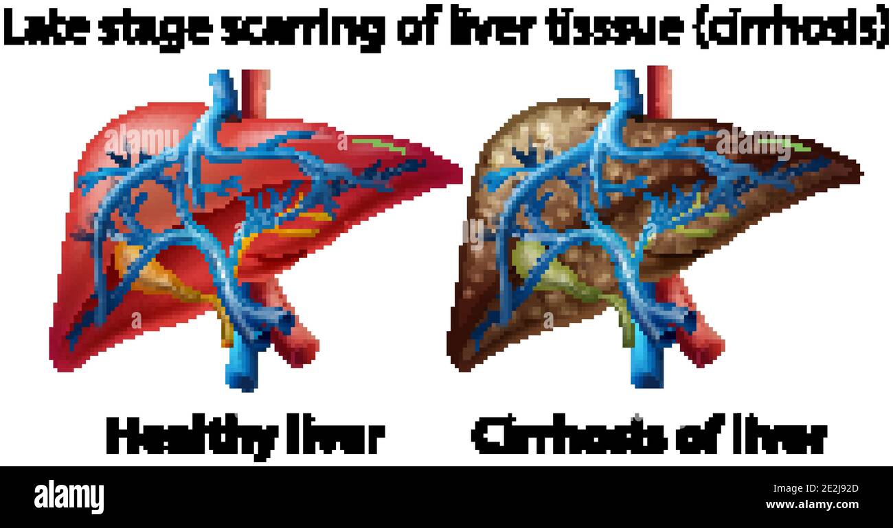 Late-stage scarring of liver illustration Stock Vector Image & Art - Alamy