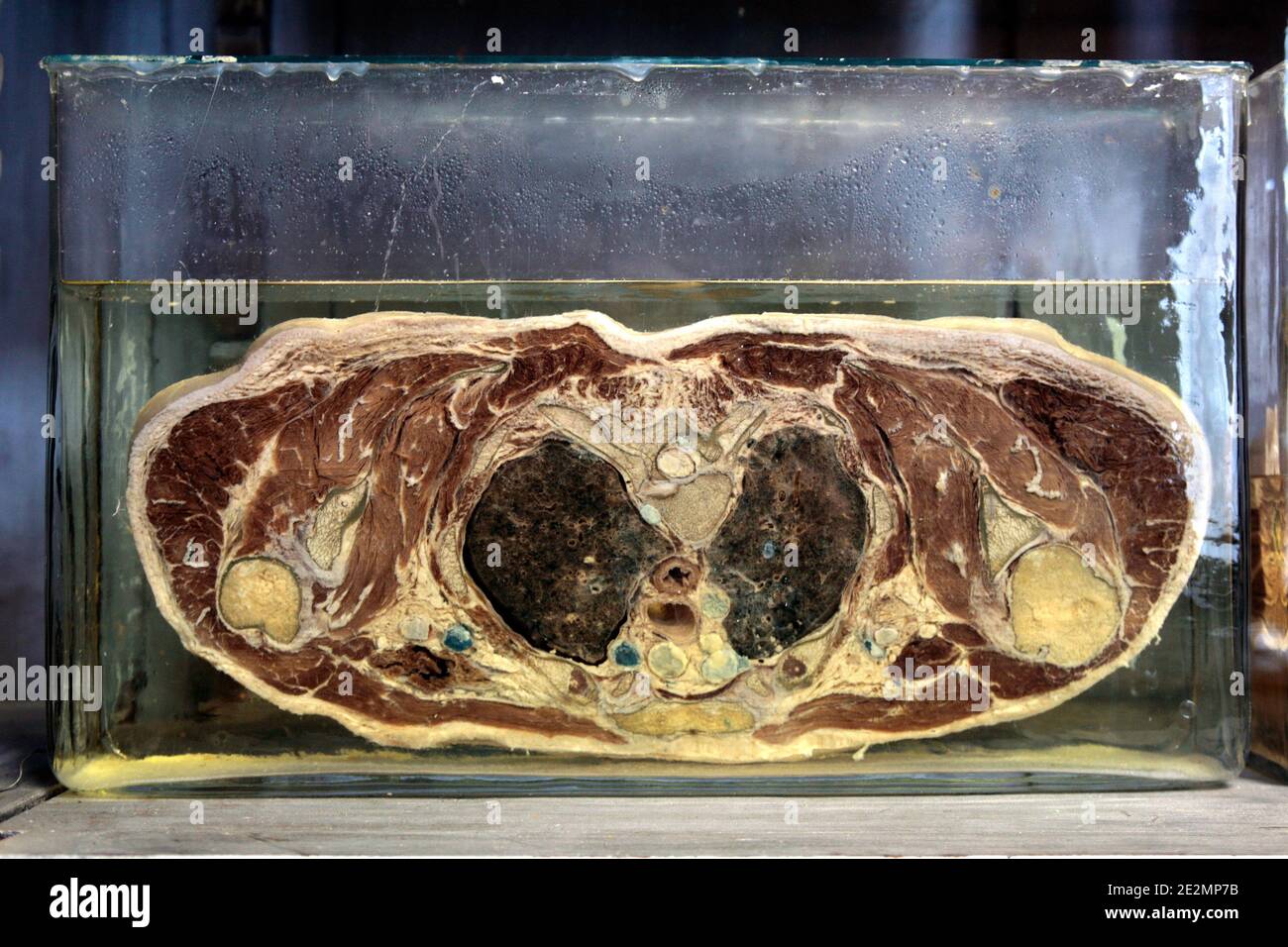 An anatomic section of a human thorax is on display in the Museum of ...