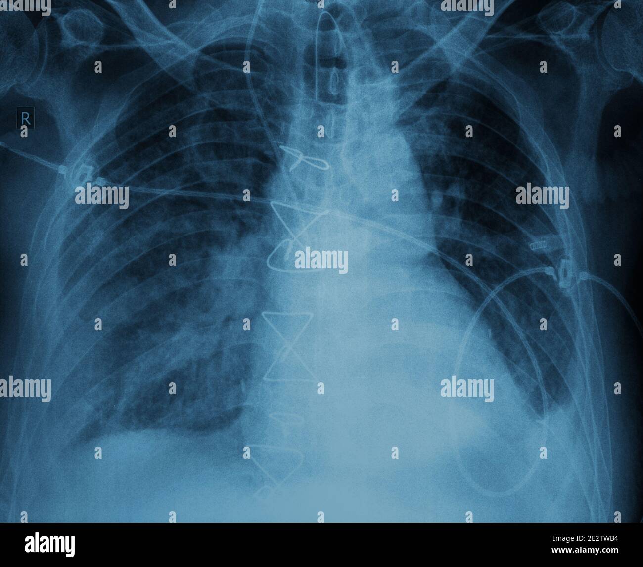 After surgery x-ray of patient with suture Stock Photo - Alamy