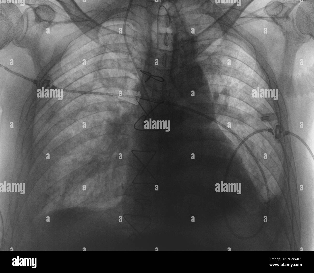 X-ray image after cardiac surgery Stock Photo - Alamy