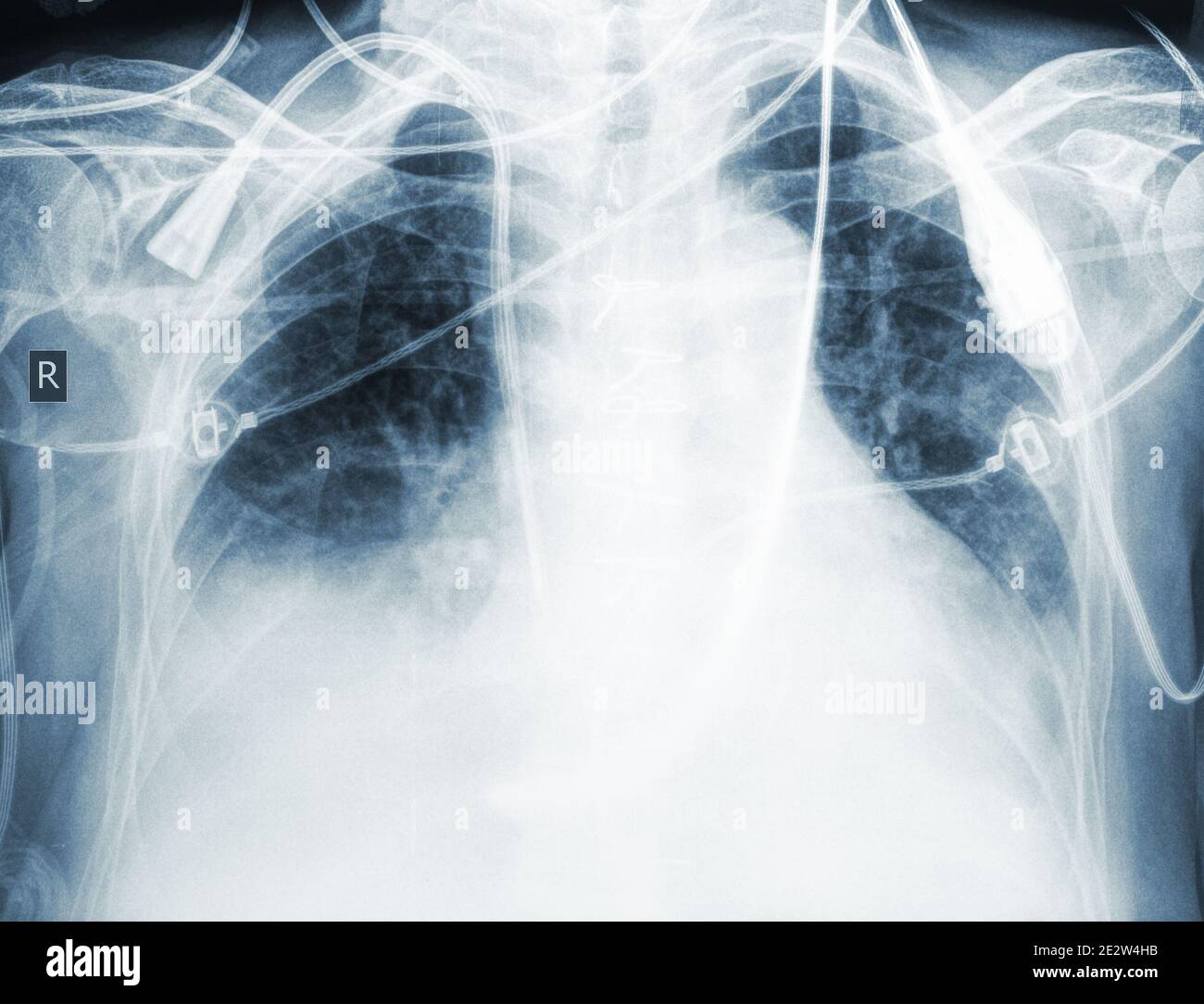Roentgen film of human, chest Stock Photo - Alamy