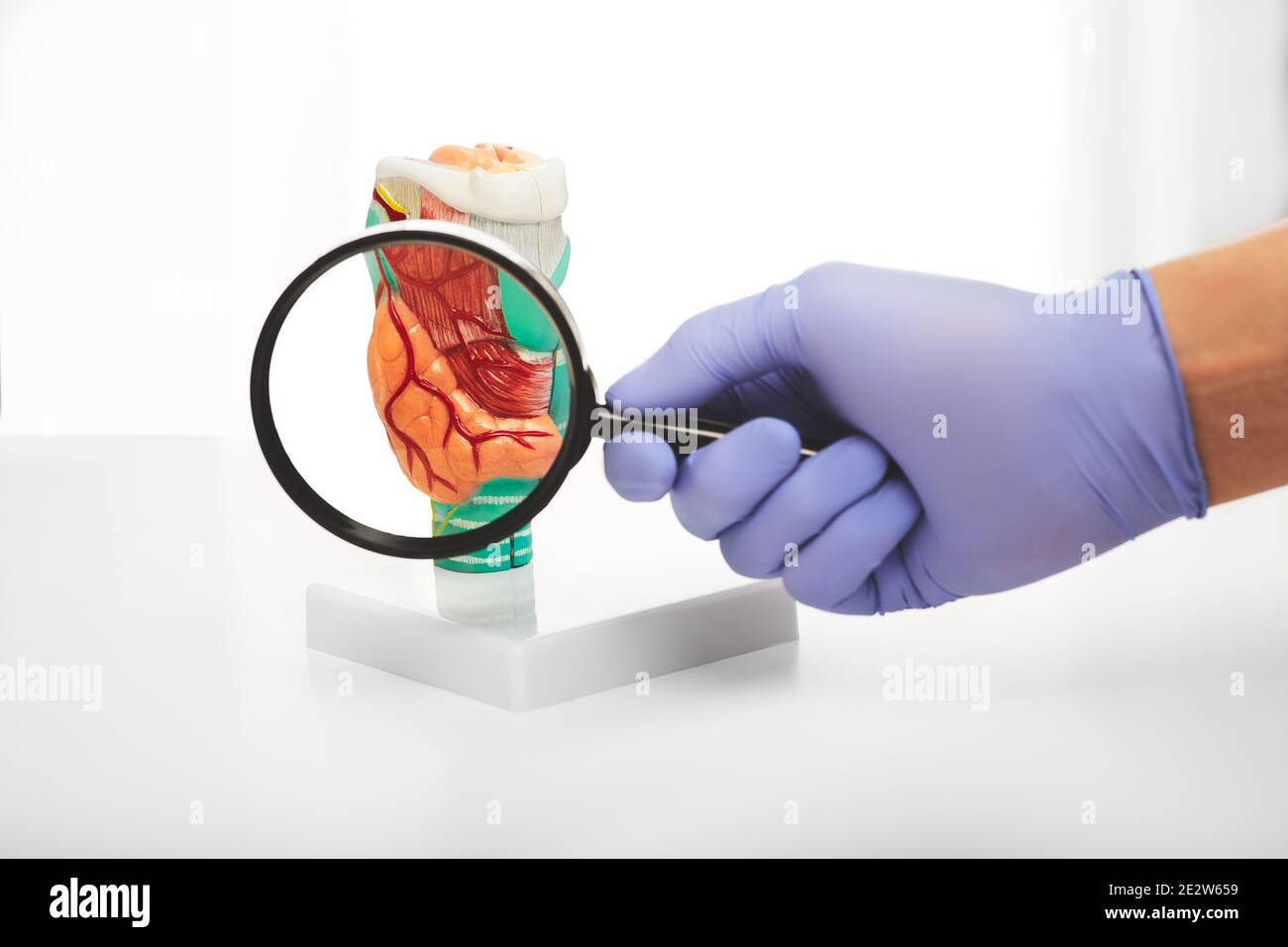 Enlarged thyroid gland, diffuse toxic goiter disease. Endocrine ...