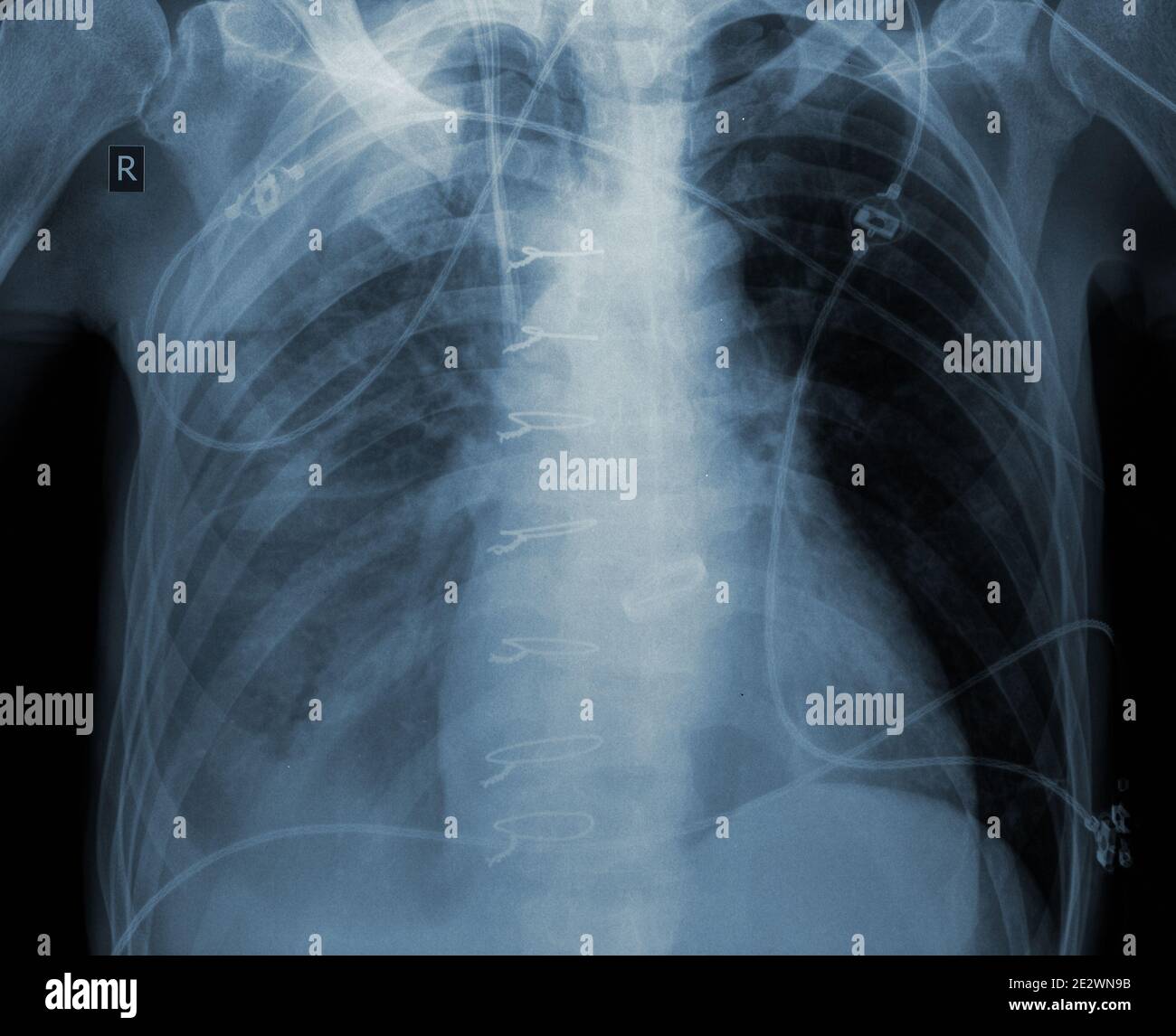 X-ray examination of patient after heart surgery Stock Photo - Alamy