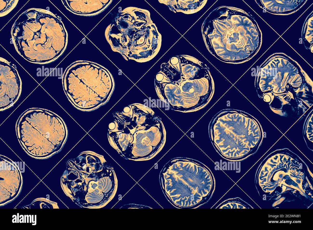 Alzheimer’s disease nmr hi-res stock photography and images - Alamy