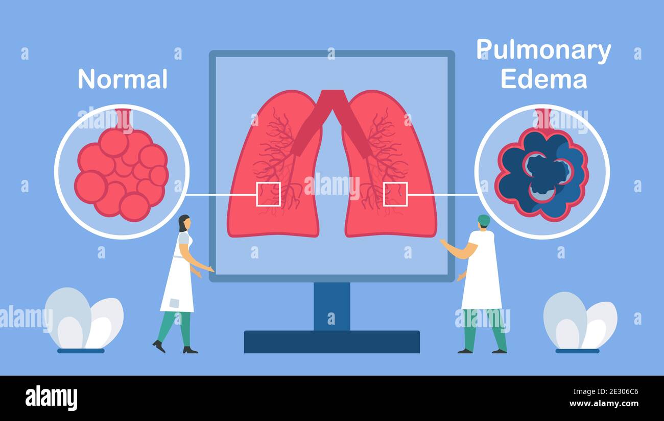 Pulmonary edema is shown good and bad alveoli. Other names is lung ... Pulmonary edema is shown good and bad alveoli. Other names is lung ...