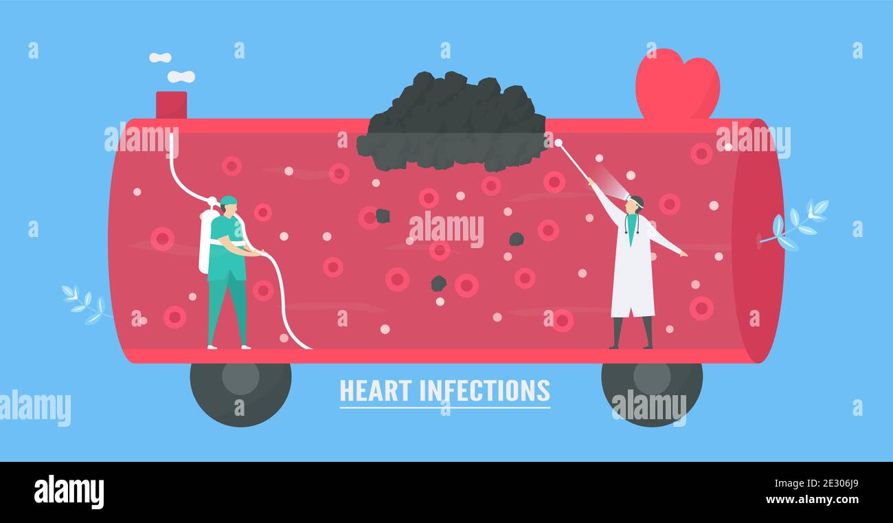 Cardiology Vector Illustration This Disease Calls Endocarditis It Is