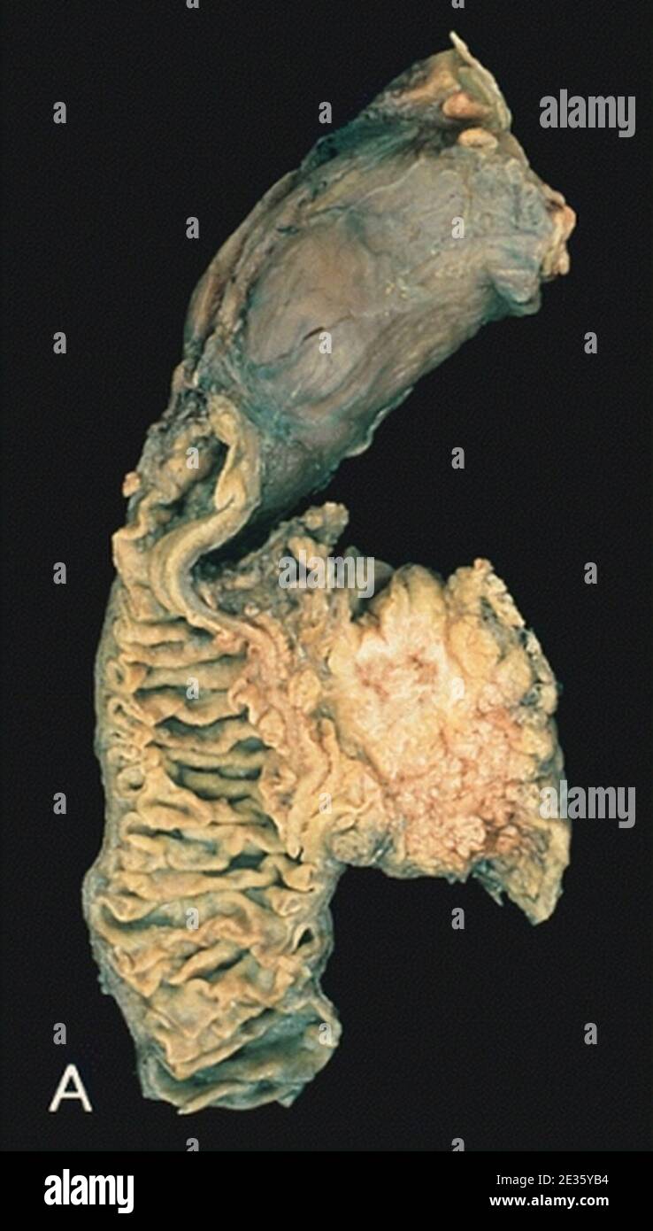 Whipple Procedure Animation