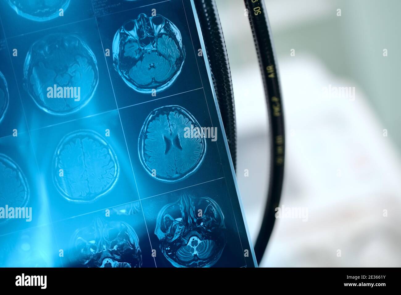 MR image in frontal section of patient brain Stock Photo - Alamy