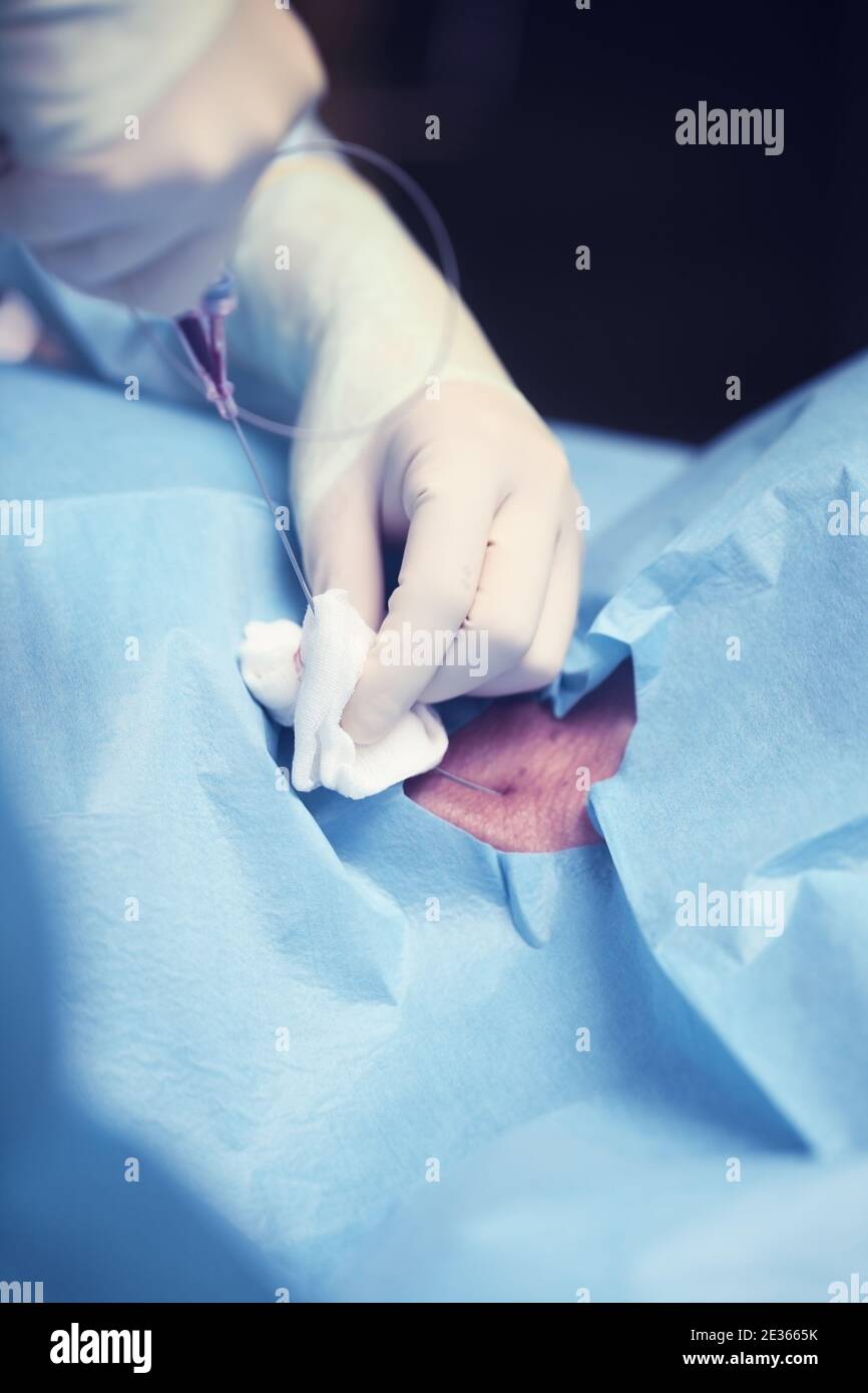 Intravenous vein therapy injection medical hi-res stock photography and ...