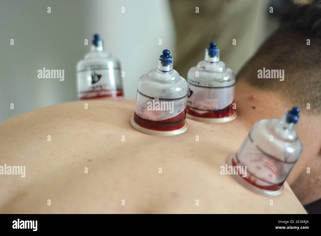 Hijama treatment hi-res stock photography and images - Alamy