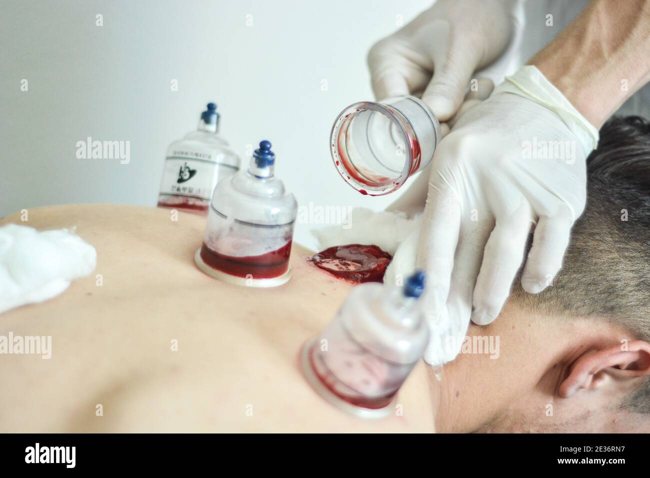 Bloodletting hi-res stock photography and images - Alamy