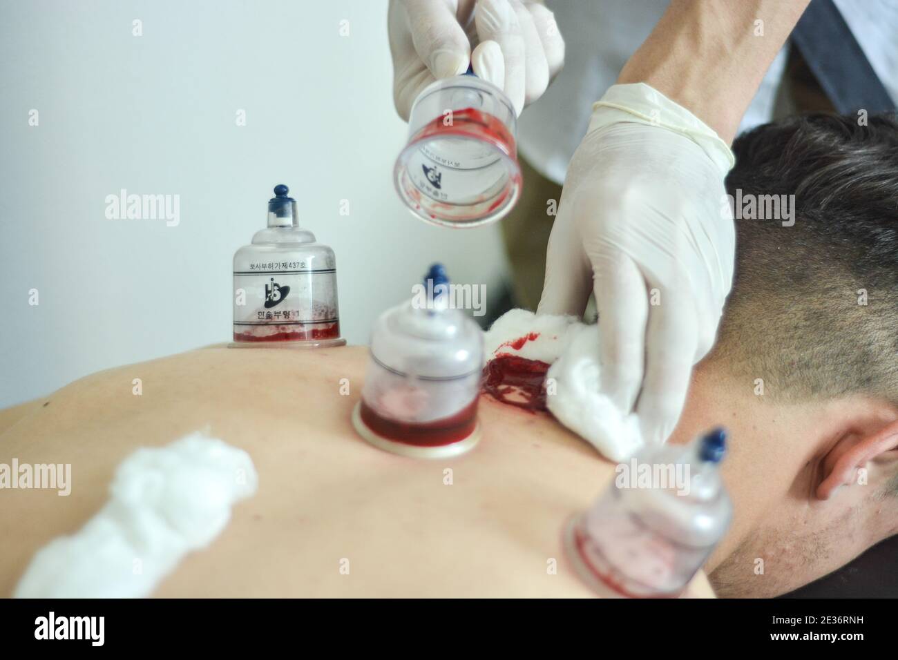 A closeup of a hajam master conducting cupping therapy on a young man ...